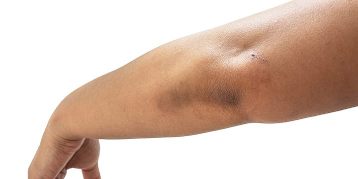 Acanthosis Nigricans Causes Symptoms And Treatments